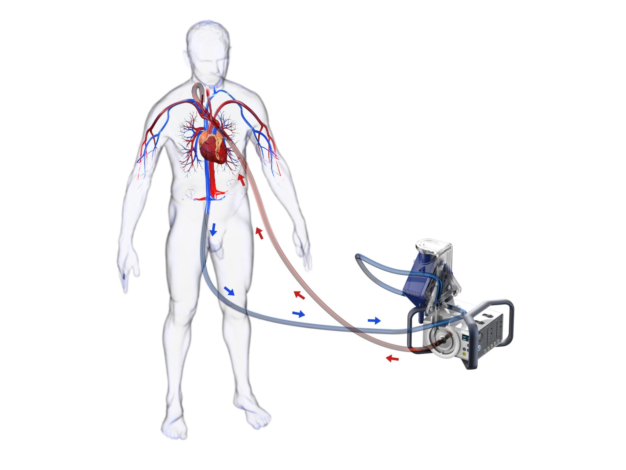 iF Design - MINI-ECMO